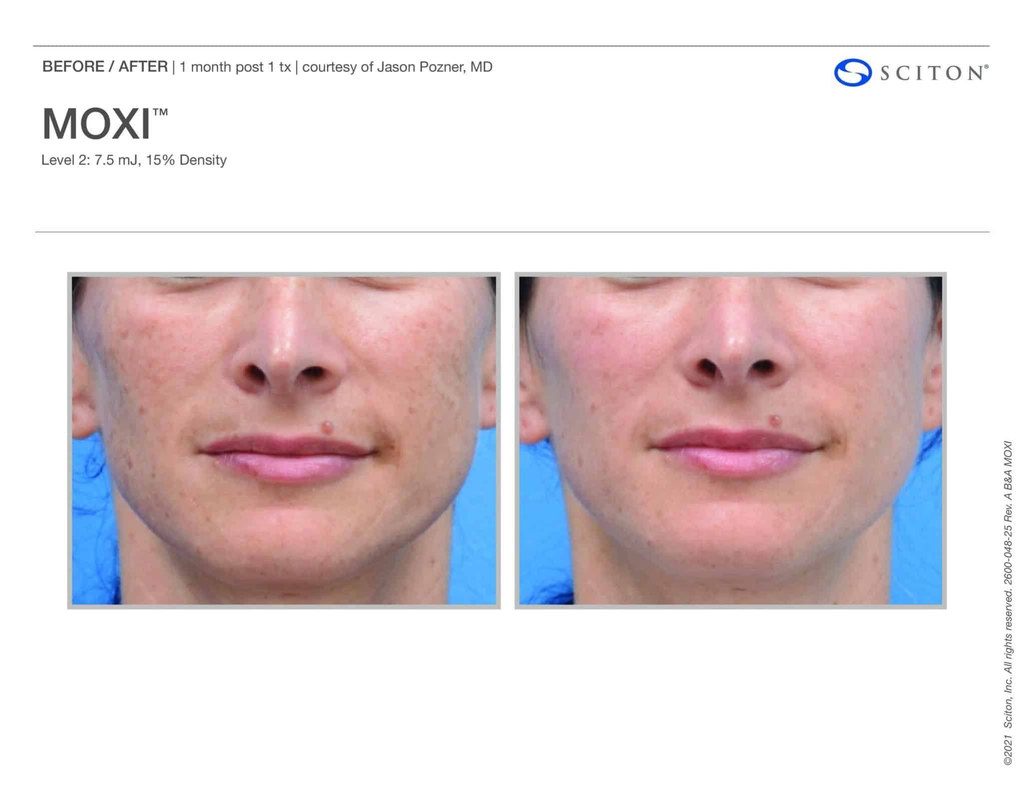 Best Moxi Laser Treatment in Cortlandt | Skin Rejuvenation