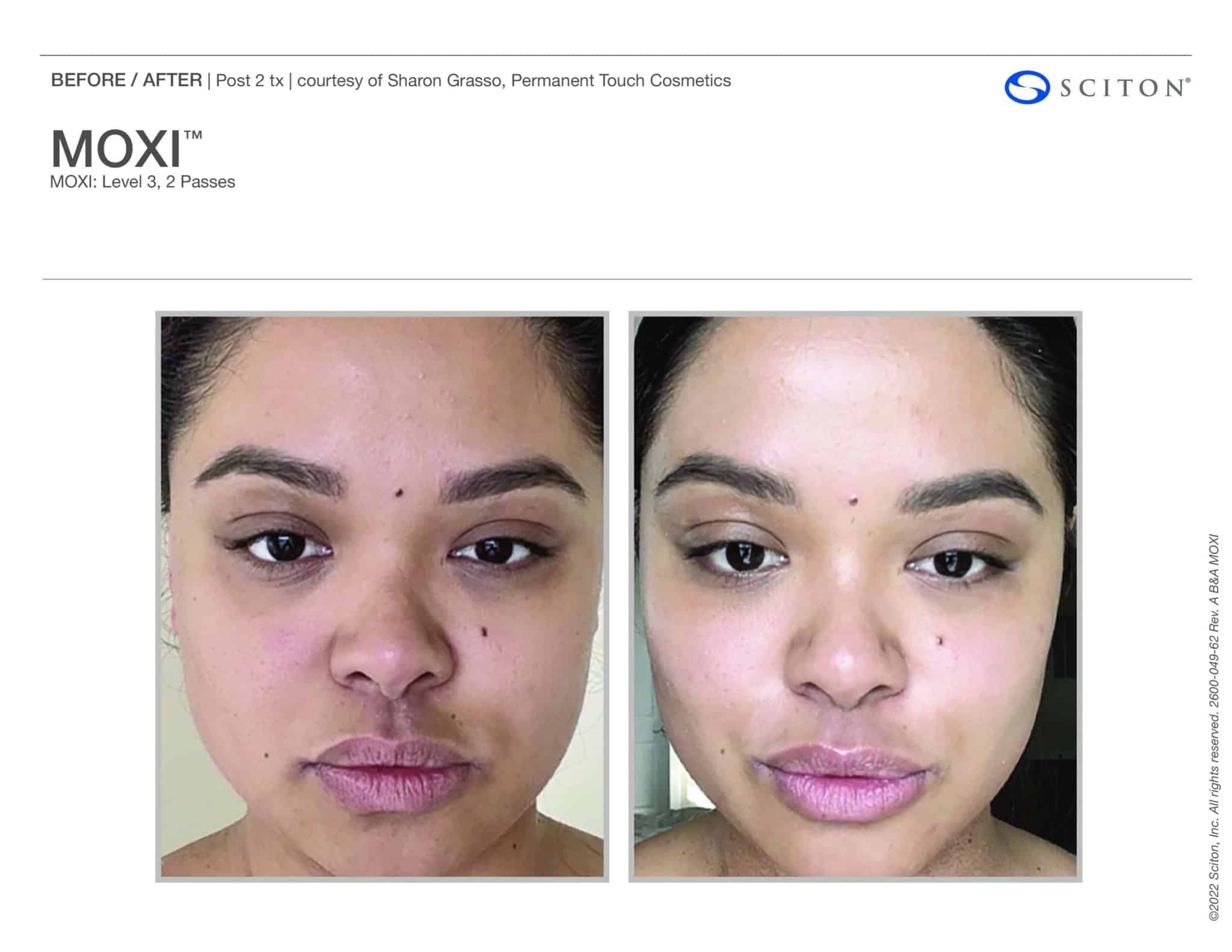 Best Moxi Laser Treatment in Cortlandt | Skin Rejuvenation